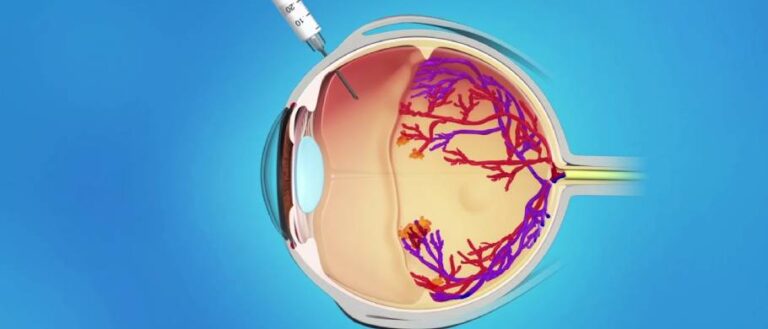 Intravitreal Anti VEGF Injection – Devgiri Memorial Hospital