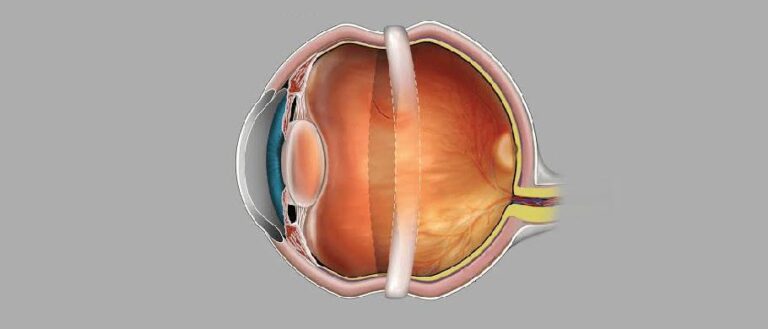 Scleral Buckle Retina Surgery – Devgiri Memorial Hospital