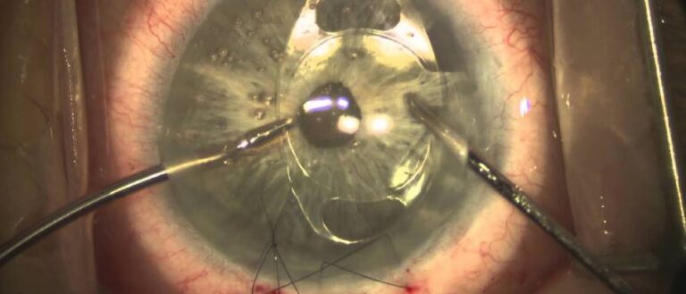 Secondary IOL Surgery – Devgiri Memorial Hospital